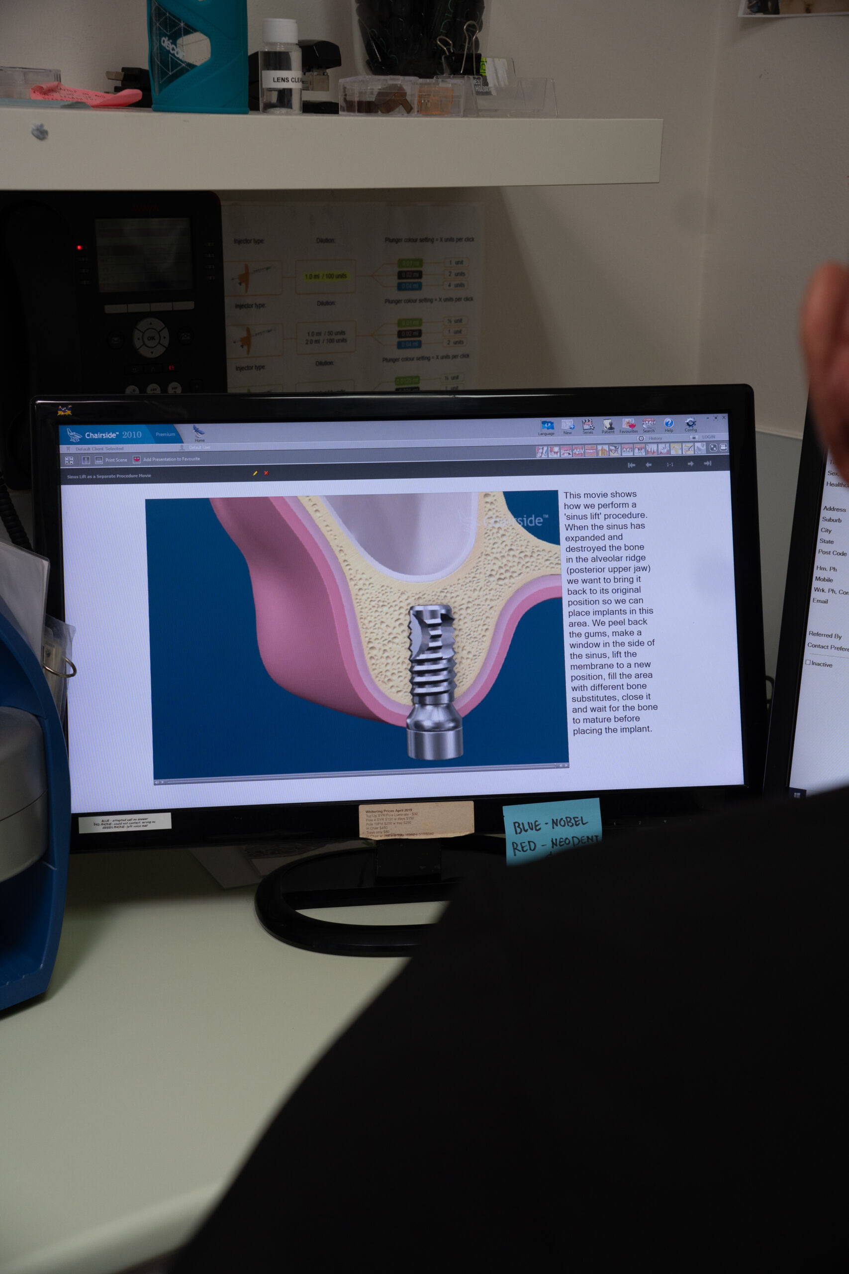 Dental Implants Melbourne | Single & Multiple Tooth Replacements