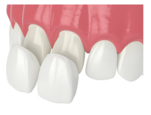 Dental Veneers Explained: Types, Procedure and Cost | CDIC