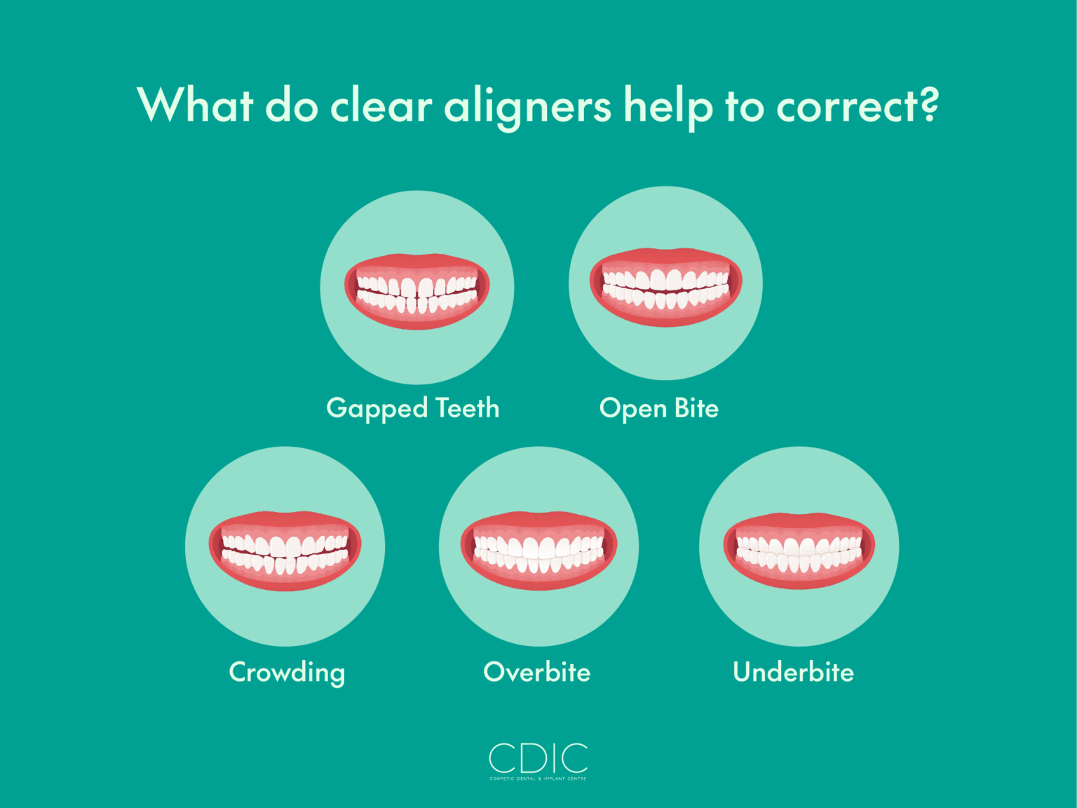 Do Clear Aligners Work? A Complete Guide to Treatment | CDIC